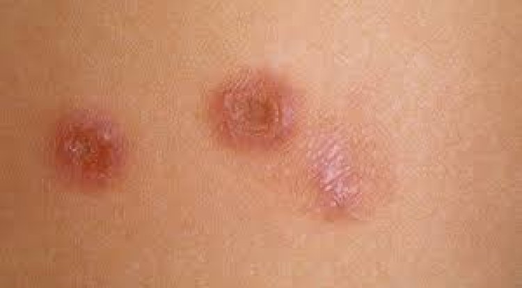 How to get rid of skin sores - Let's Share What We Know